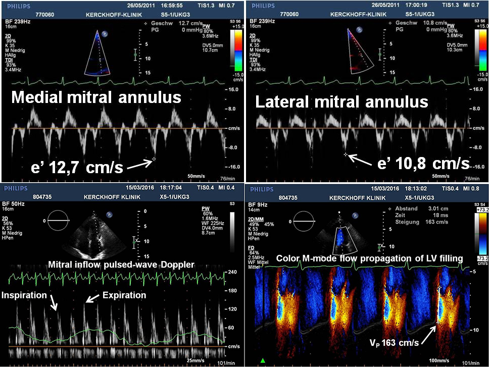 Constrictive pericarditis: role of echocardiography and magnetic resonance imaging